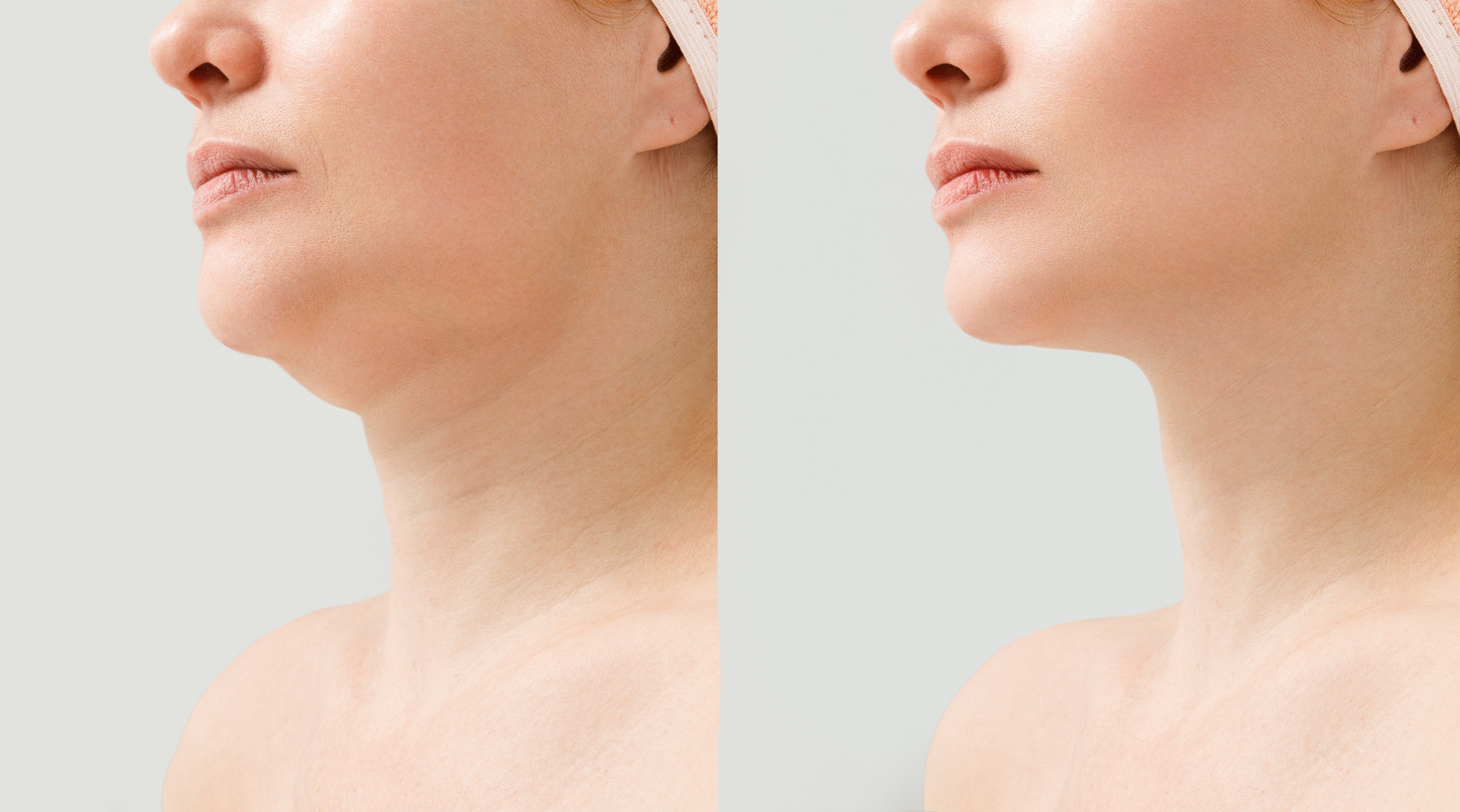 How to Get Rid of Double Chin and Achieve a V-Shaped Face